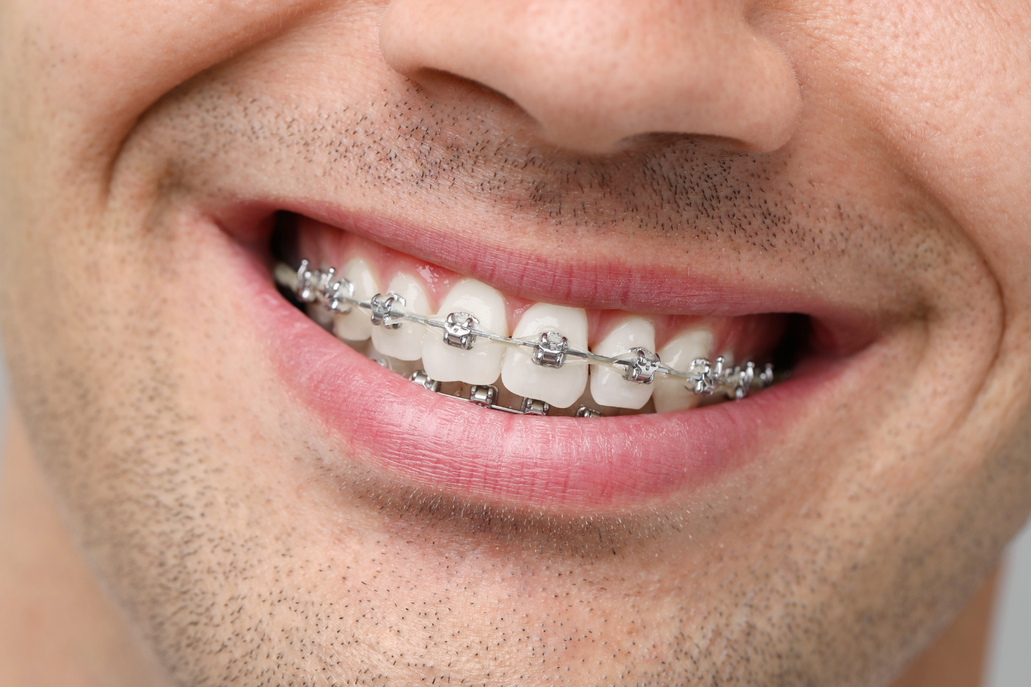 Tipos de brackets: diferencias, ventajas y cuál elegir - Ortodoncia en ...